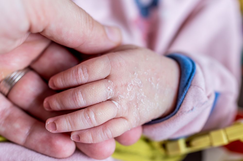 What are the causes of dry skin in children and how to treat them ...